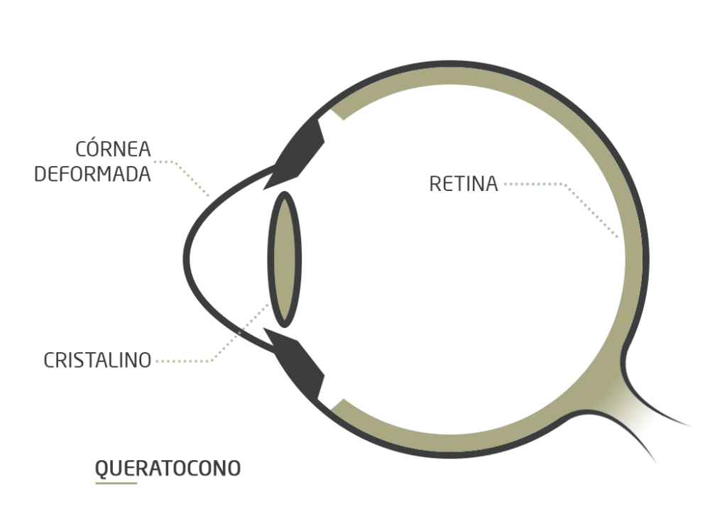 Queratocono | Qué es y tratamiento - Clínica Rahhal