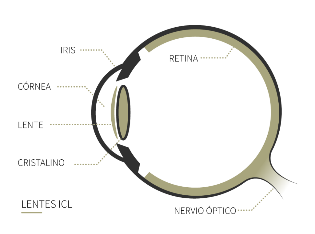 Lentes ICL (lentes intraoculares): Qué son y opiniones de pacientes ...