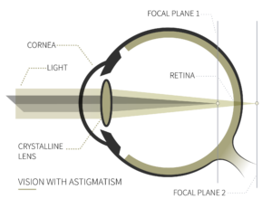 Astigmatism | Refractive surgery - Clínica Rahhal Valencia