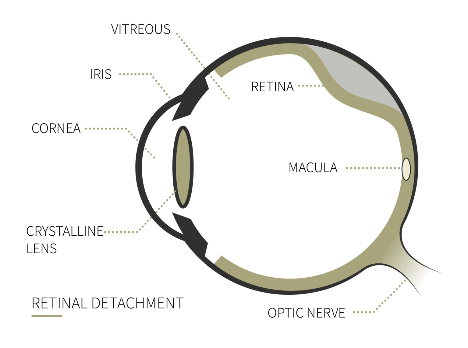 Retinal Detachment | Diagnosis and treatment-Clínica Rahhal