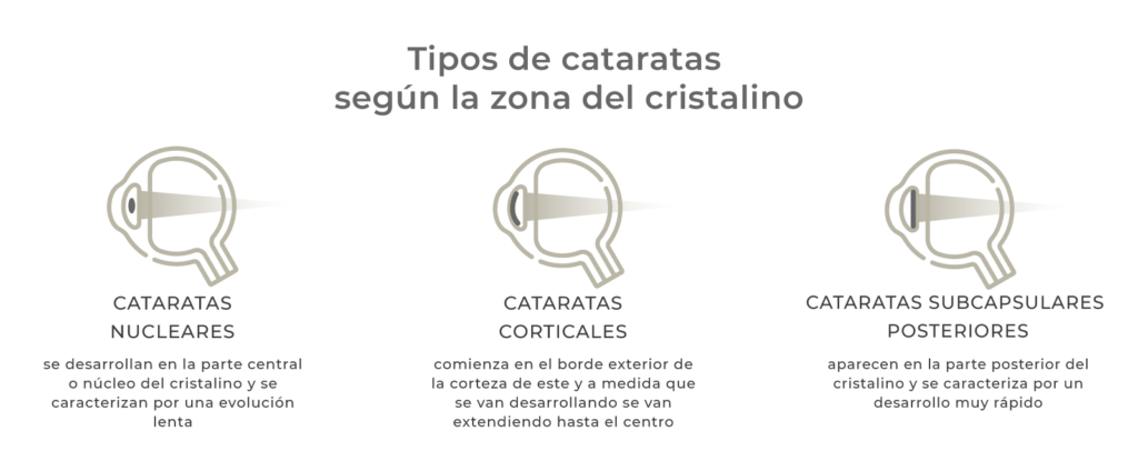 Cataratas: Qué son, tipos, síntomas y tratamiento