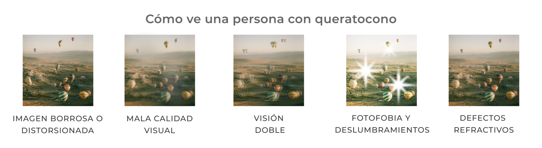 Queratocono: Qué es, síntomas, causas y tratamientos