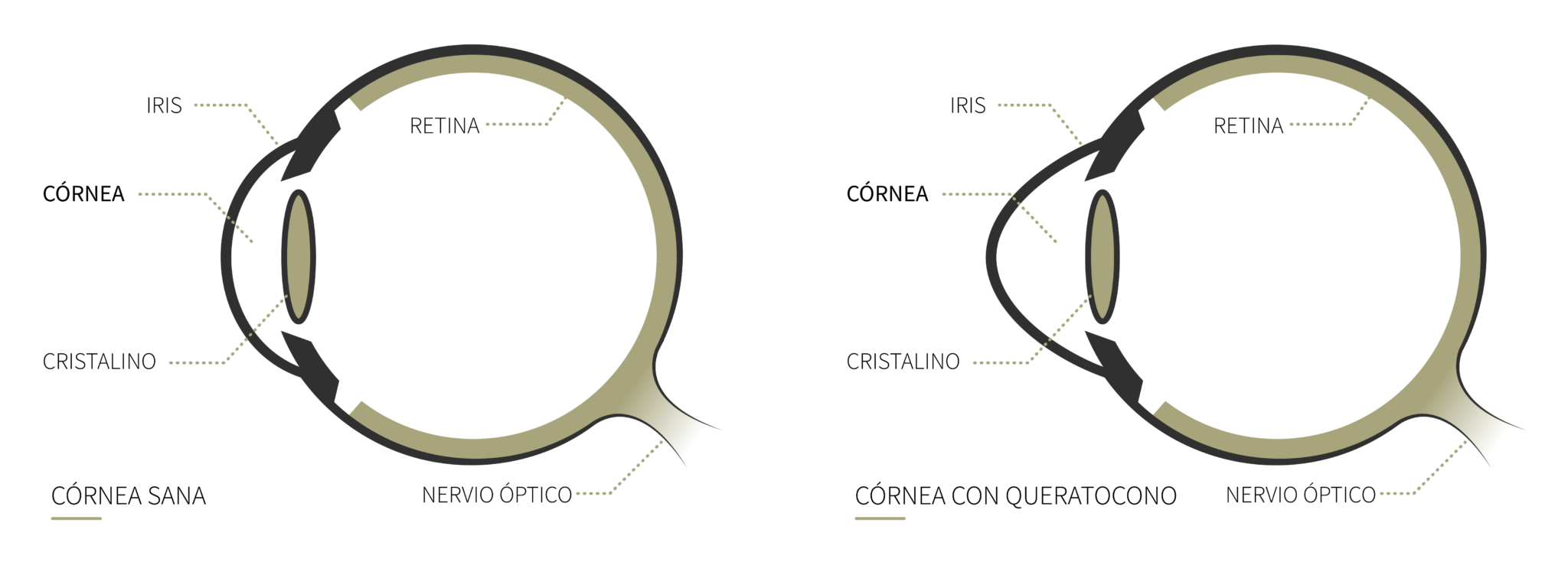 Queratocono: Qué es, síntomas, causas y tratamientos