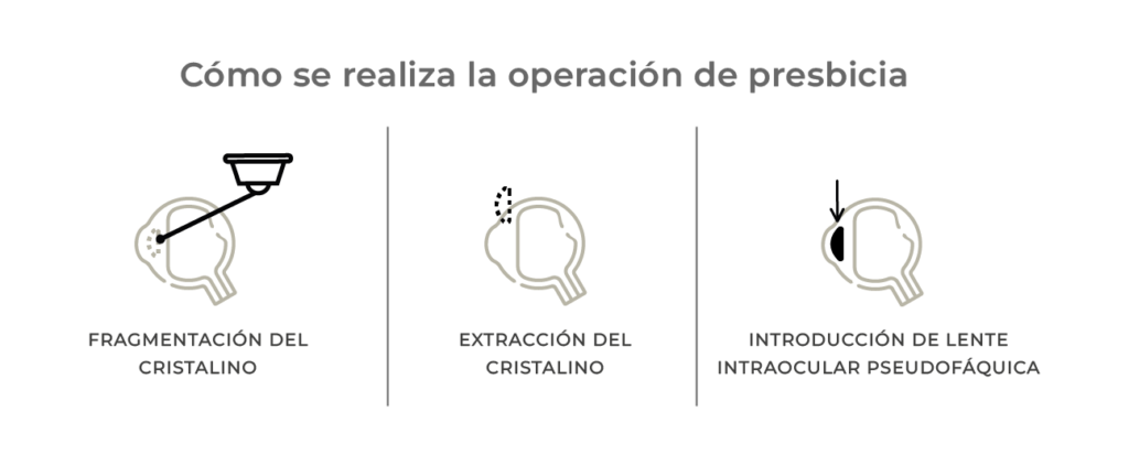 Todo lo que debes saber antes de operarte de presbicia