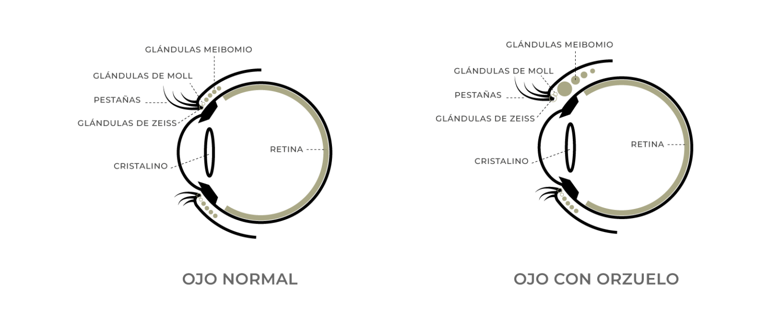 Orzuelo: Qué es, causas y tratamiento - Clínica Rahhal
