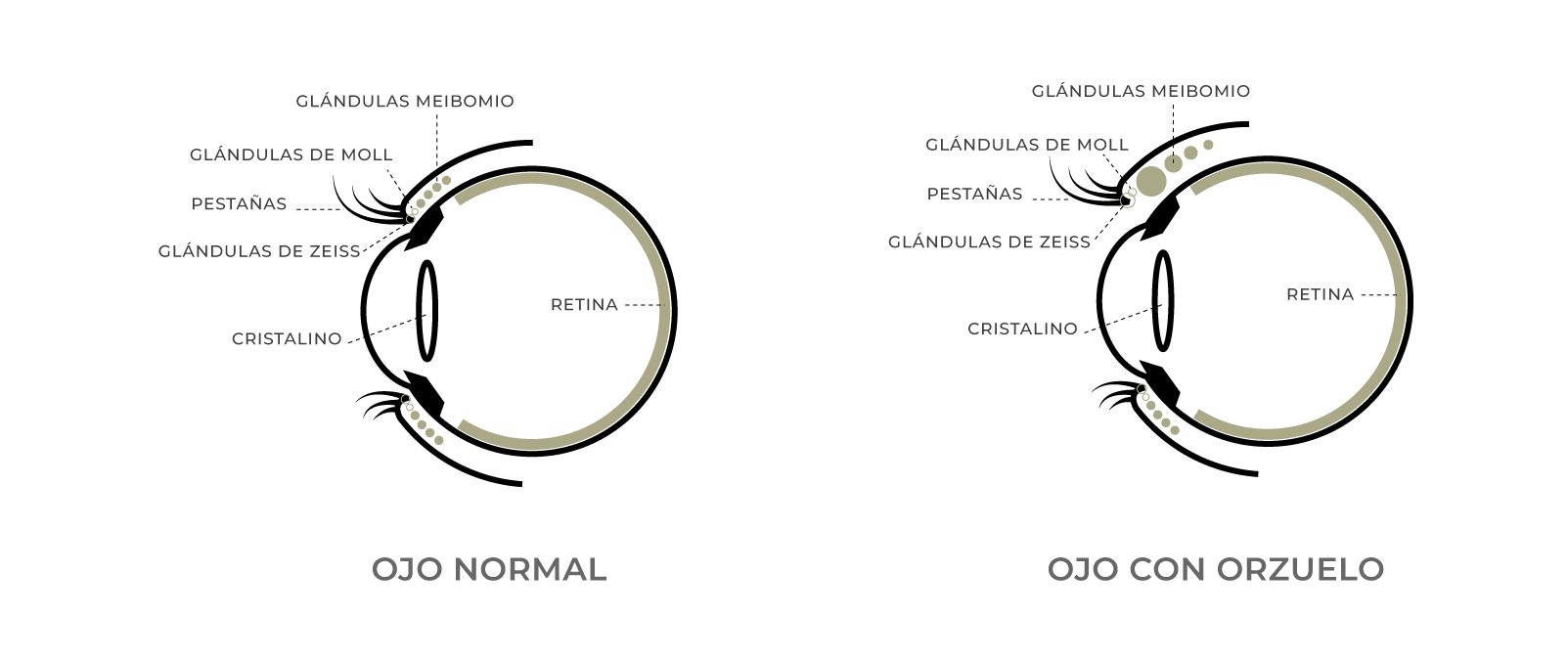 Orzuelo: Qué es, causas y tratamiento - Clínica Rahhal
